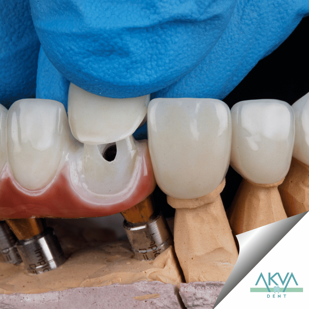 Porcelain Veneer | AkvaDent Dental Clinic